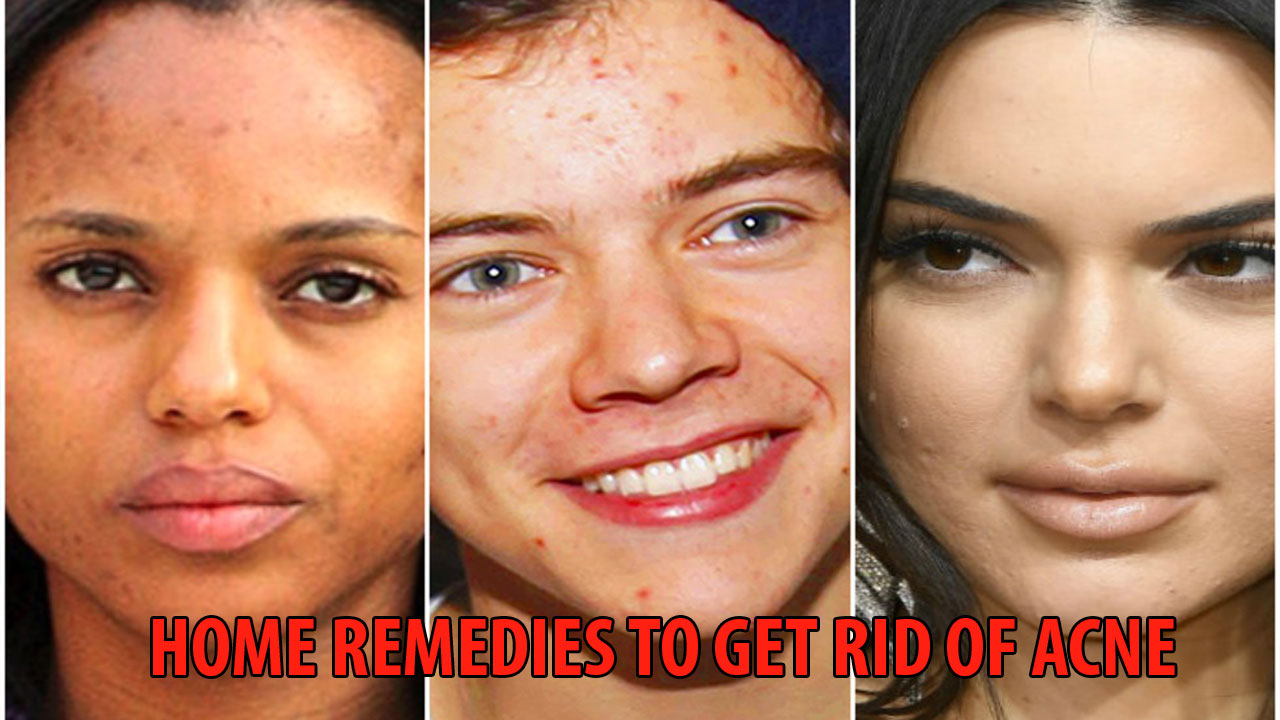 Facing Acne Problems? Check These 3 Home Remedies Which Will Help You ...